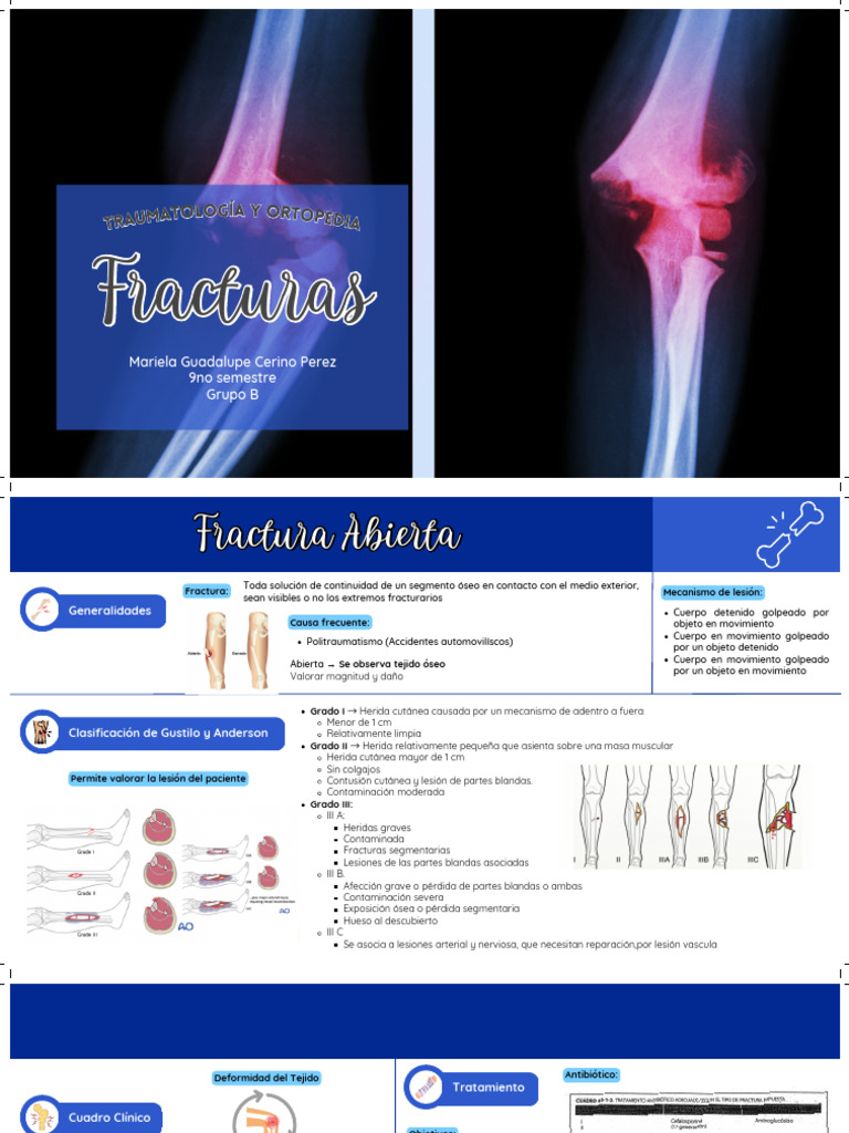 Traumatología y Ortopedia - Fracturas | PDF
