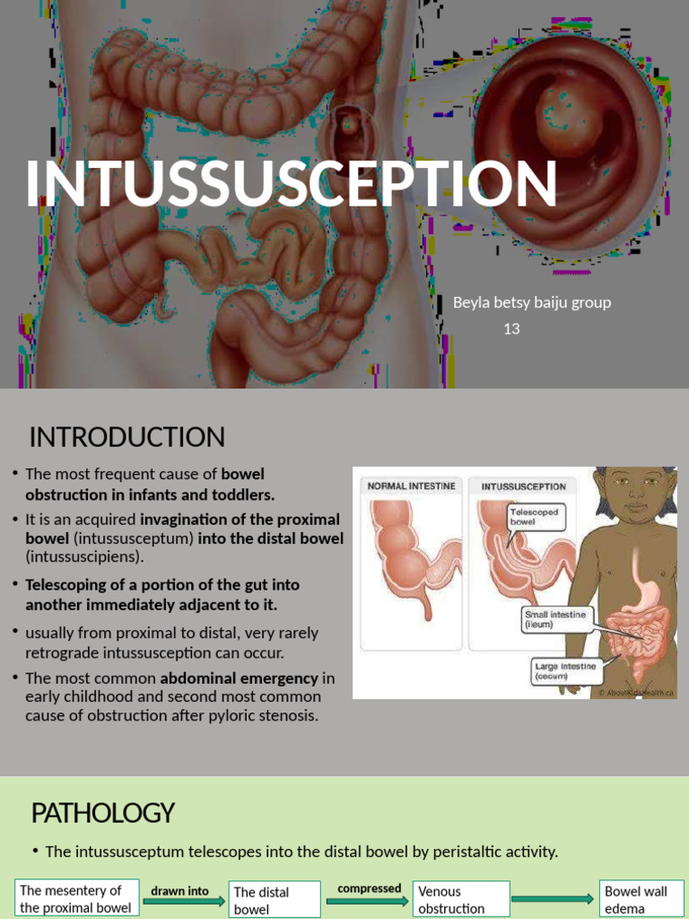 Intussusception | PDF