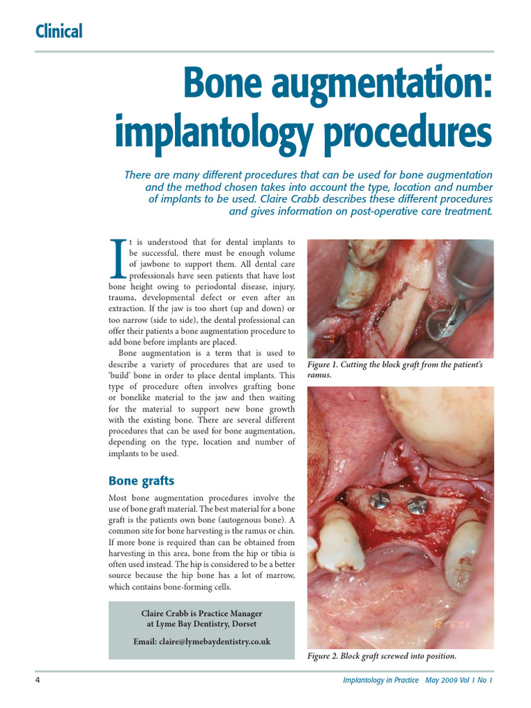 BONE AUGMENTATION | PDF