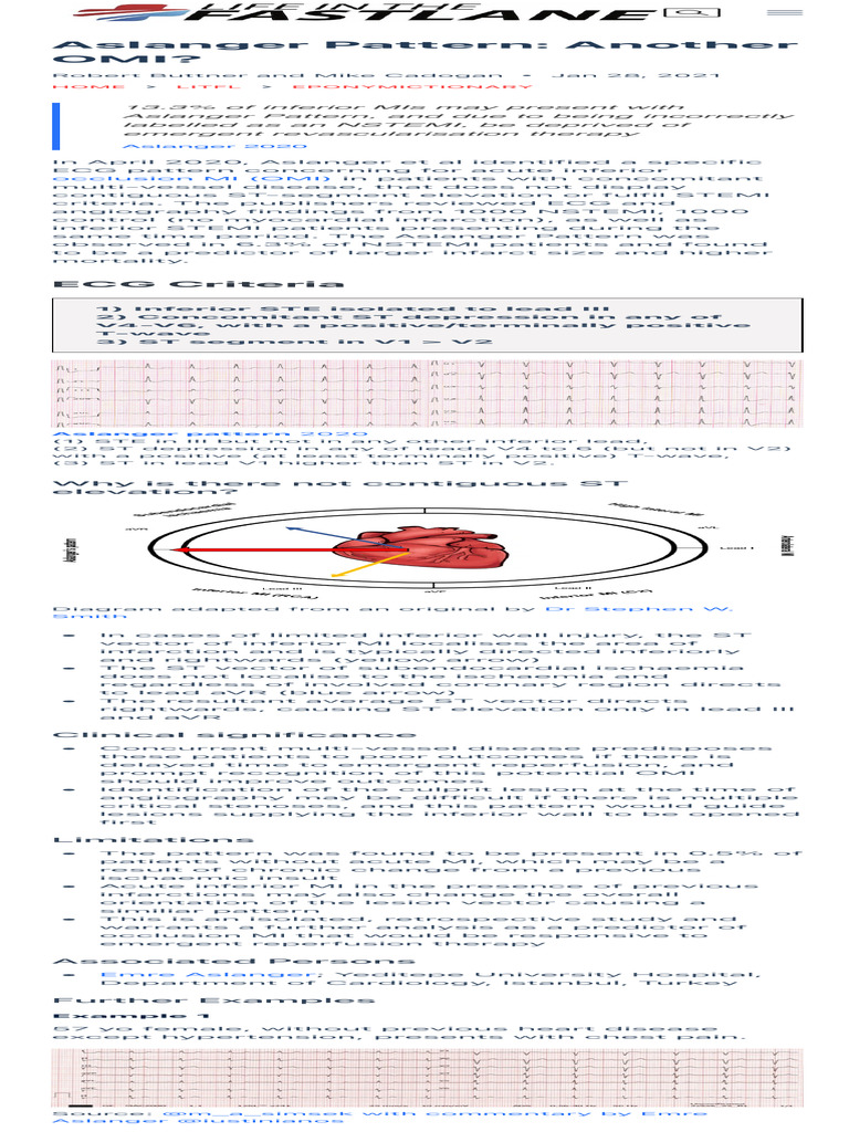 Aslanger Pattern Another OMI - LITFL - Medical Eponym Library | PDF