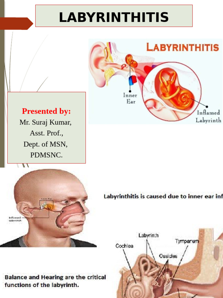 Labyrinthitis | PDF