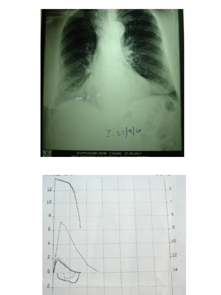 Mixed Pattern Spirometry | PDF