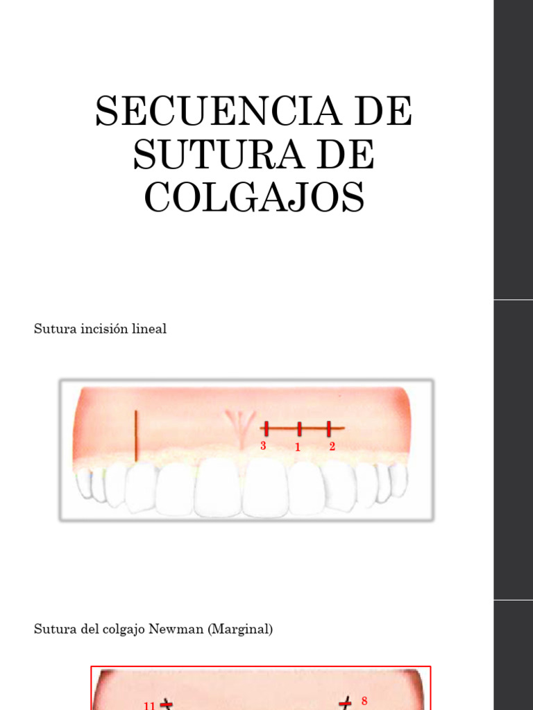 Colgajos y Suturas | PDF