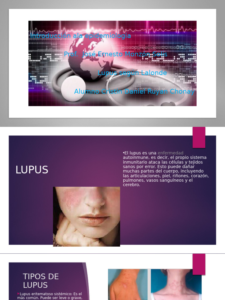 Lupus | PDF