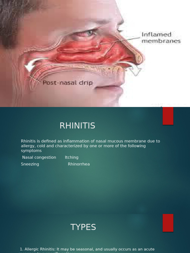 Rhinitis | PDF