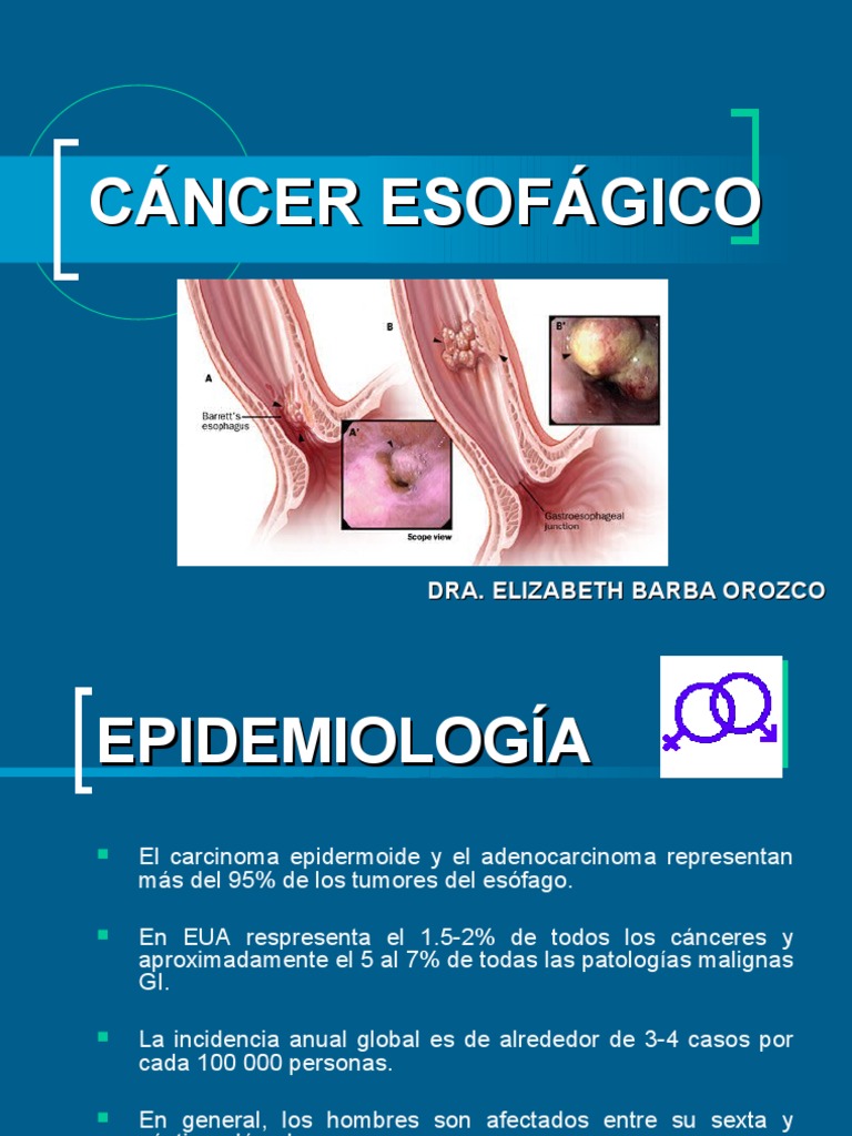 Cáncer Esofágico | PDF | Cáncer de esófago | Cáncer