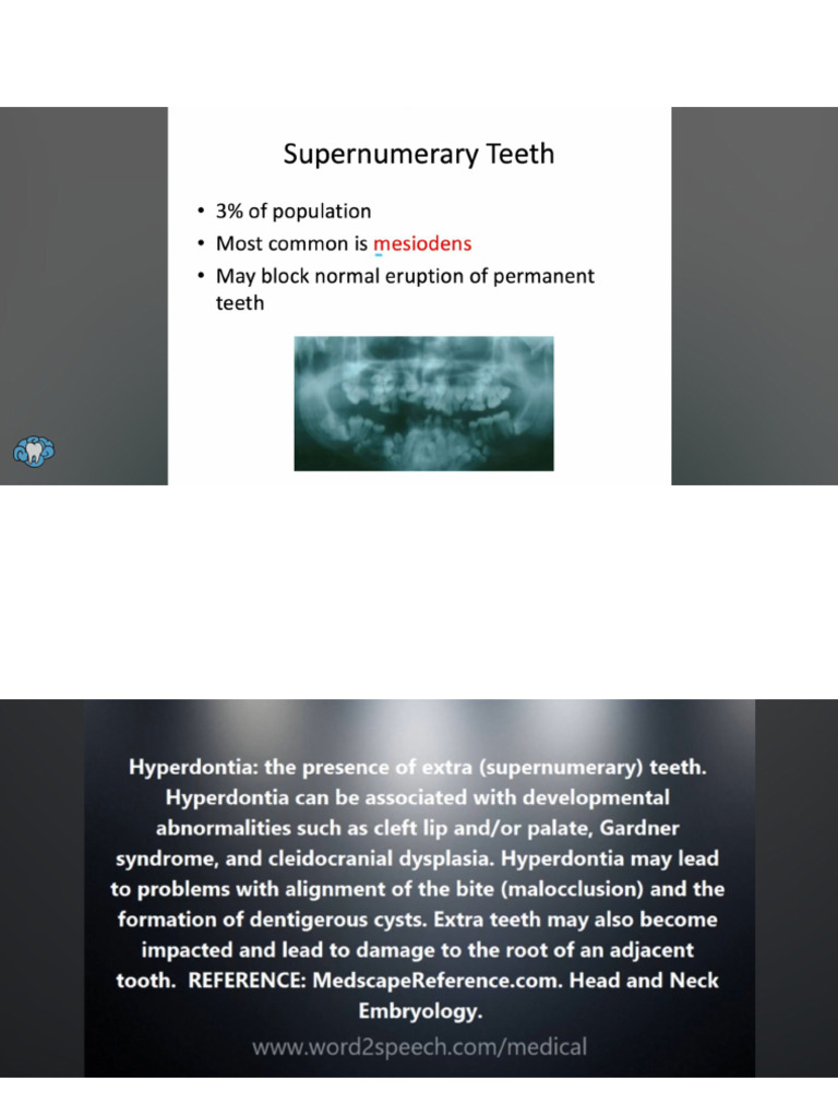 Supernumerary Teeth | PDF