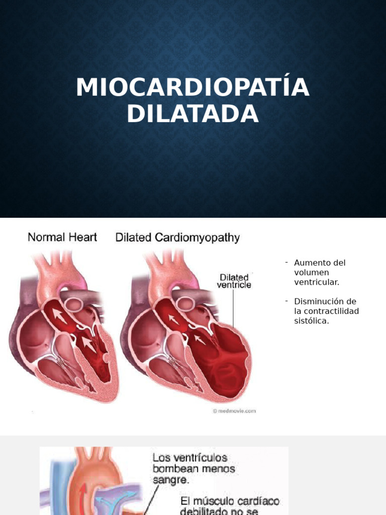 Miocardiopatía Dilatada | PDF