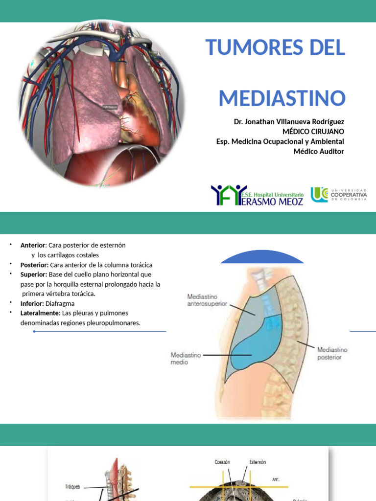 Tumor de Mediastino DR Villanueva | PDF