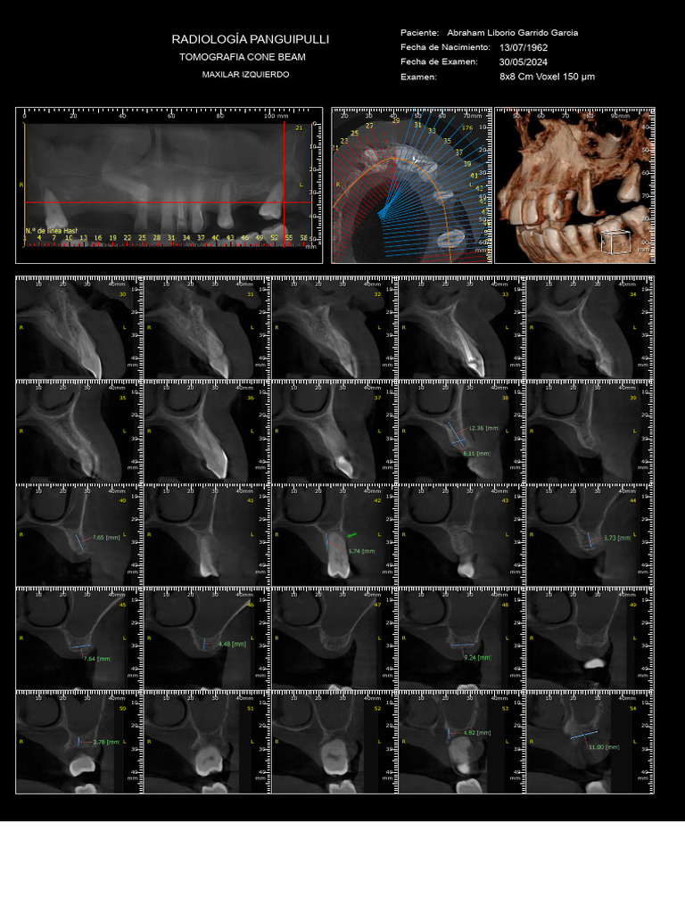 Abraham Garrido CBCT Maxilar Izquierdo | PDF