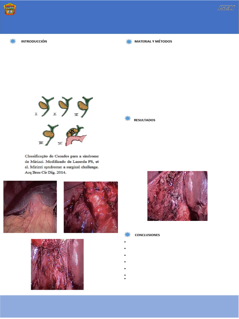 Síndrome de Mirizzi Tipo I | PDF