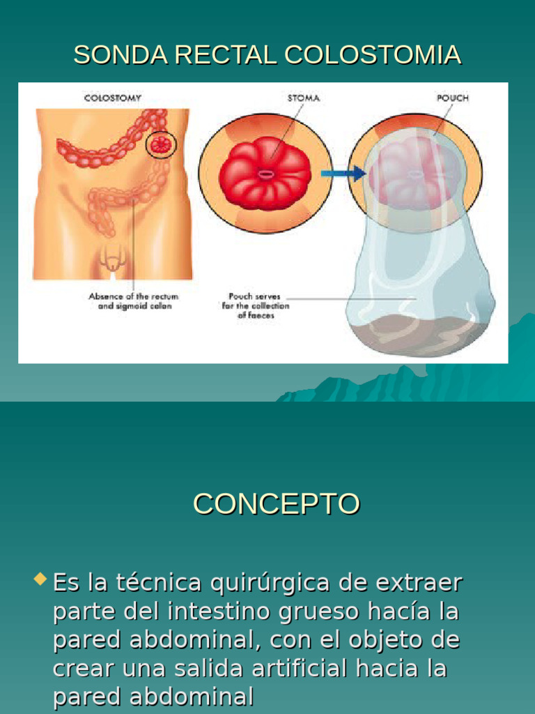 Sonda Rectal Colostomia HENRRY IV SEMESTRE | PDF