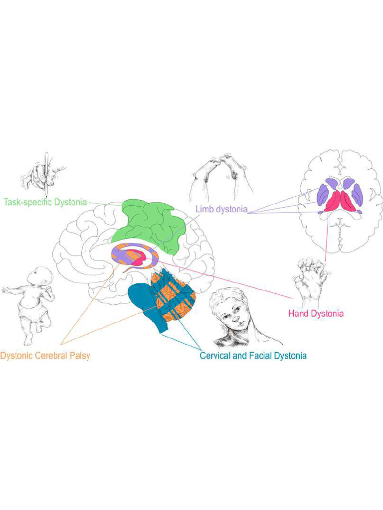 Dystonia Types | PDF