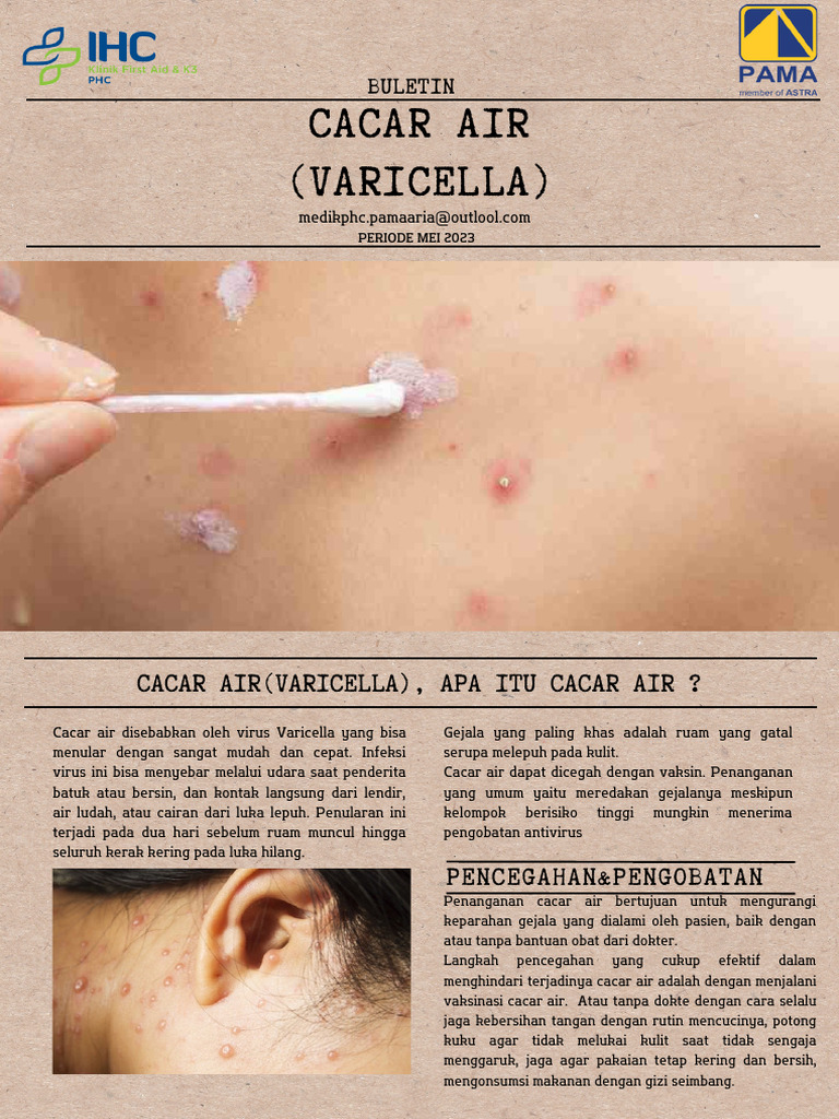 Varicella Atau Cacar Air | PDF