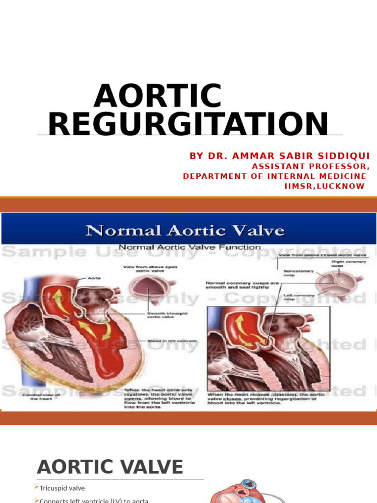 Aortic Regurgitation Overview and Management | PDF | Heart Valve ...