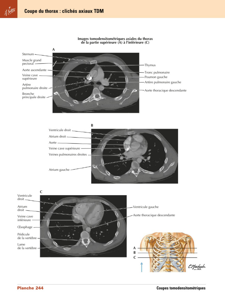 Coupe Du Thorax Clichés Axiaux TDM | PDF