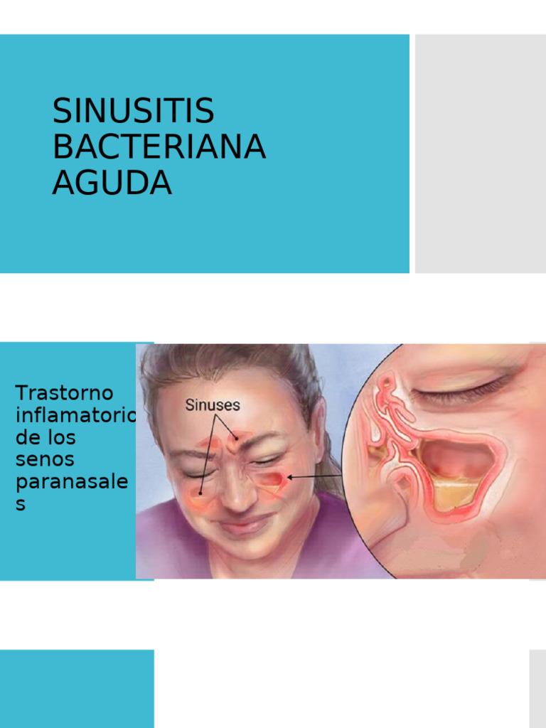 Sinusitis 2 | PDF