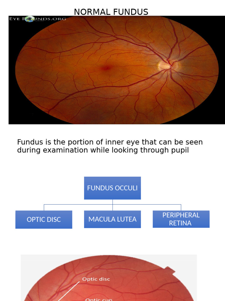 Normal Fundus 1 | PDF