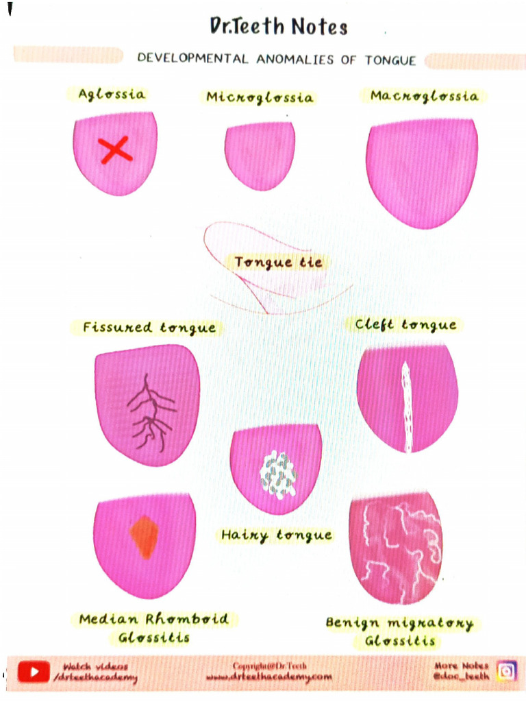 Anomalies of Tongue | PDF