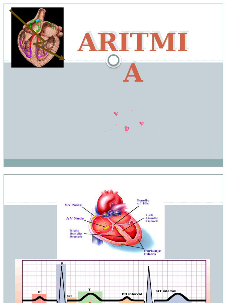 ARITMIA | PDF