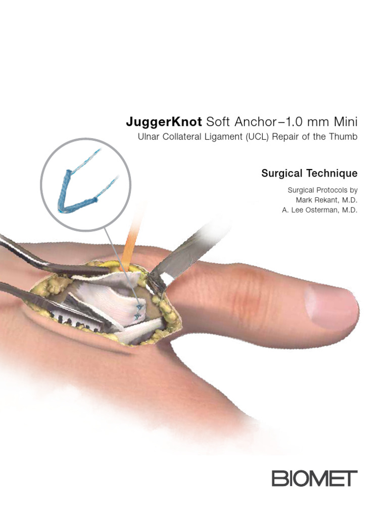 JuggerKnot Mini Anchor for UCL Repair | PDF | Surgical Suture | Surgery