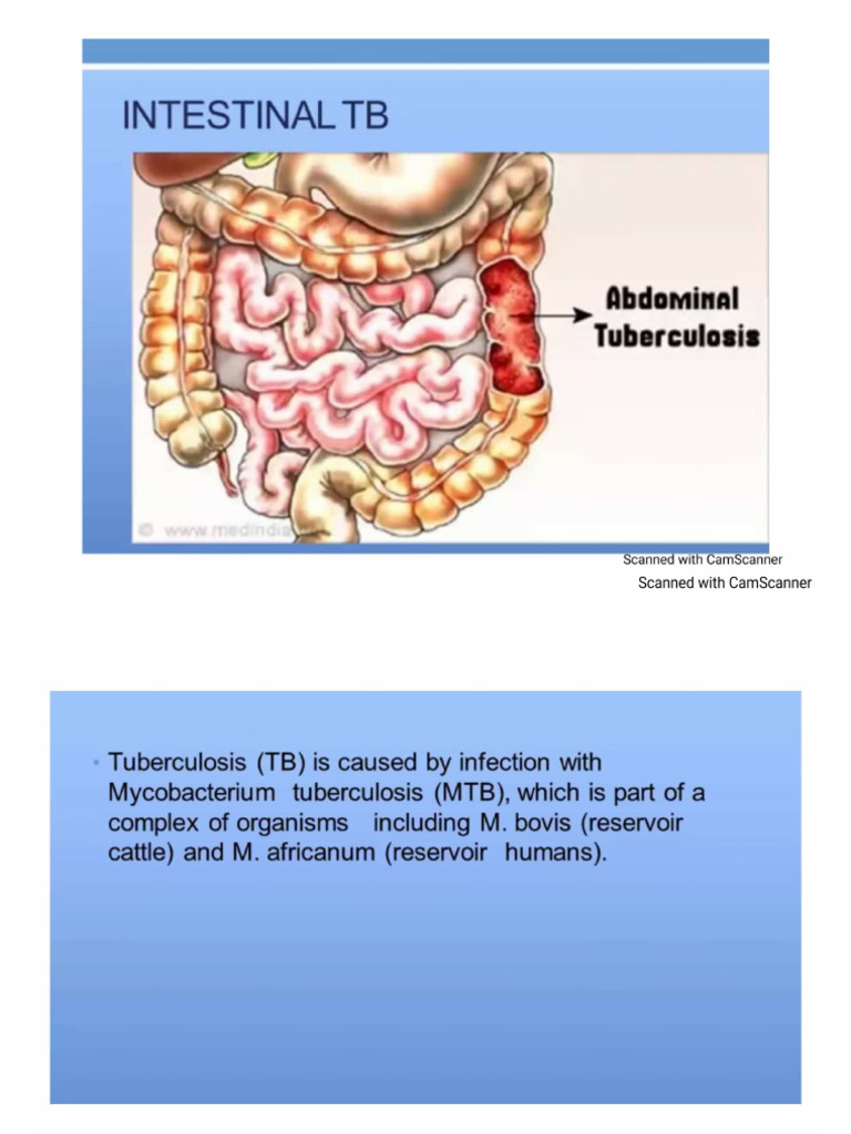 Abdominal T.B | PDF