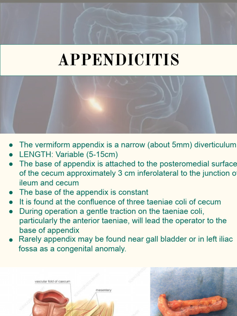 Appendicitis | PDF