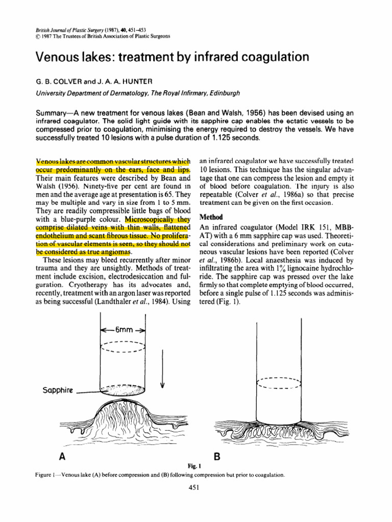 Venous Lakes-Treatment by Infrared Coagulation | PDF
