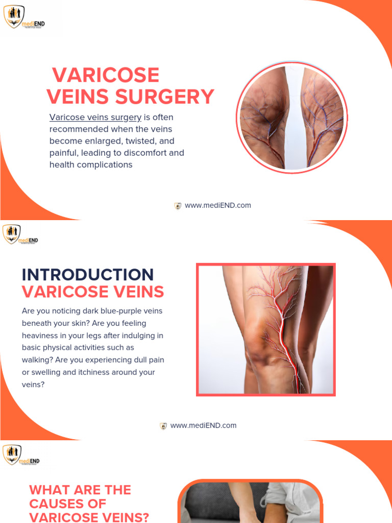 Varicose Veins Symptoms, Causes and Treatments | PDF
