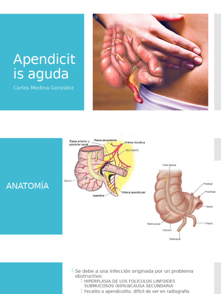 Apendicitis | PDF