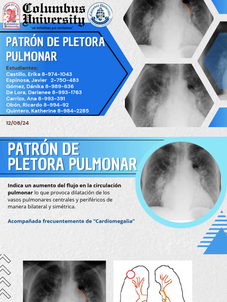 Equipo #3 Patrón de Plétora Pulmonar - #1 | PDF | Pulmón | Ciencia y ...