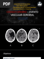 Escala ASPECTS | PDF