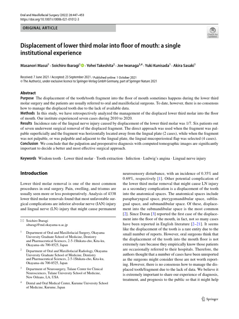 Displacement of Lower Third Molar Into Floor of Mouth: A Single ...