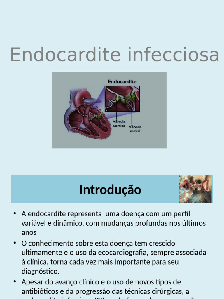 Endocardite | PDF