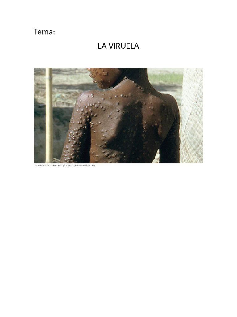 Tema: La Viruela | PDF