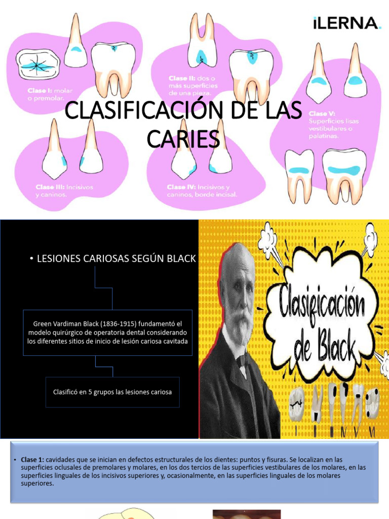 5.CLASIFICACIÓN DE LAS CARIES SEGÚN BLACK | PDF