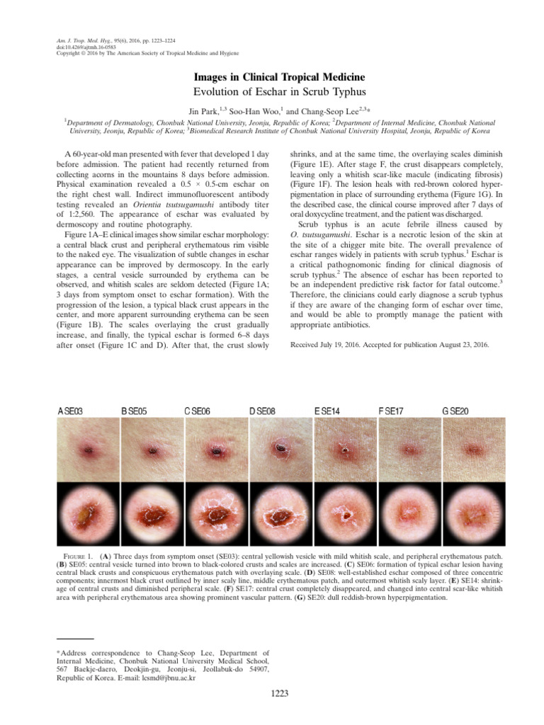 Evolution of Eschar in Scrub Typhus | PDF | Health Sciences | Science ...