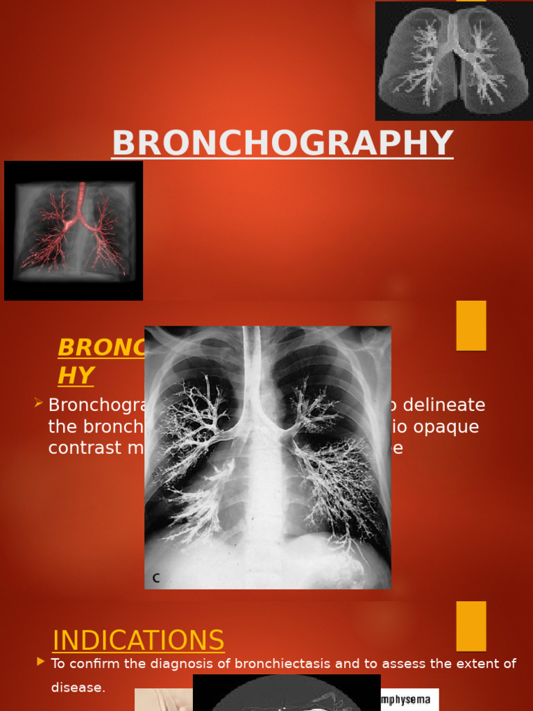 Bronchography | PDF