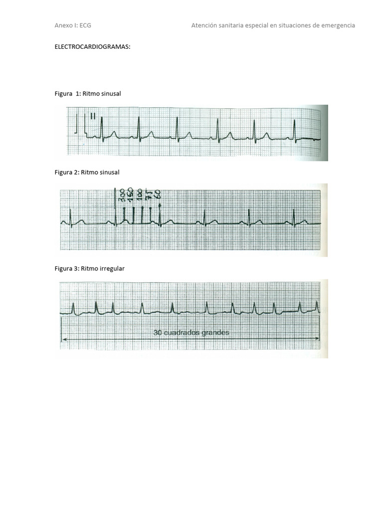 Ejercicio Ecg Final Corregido | PDF
