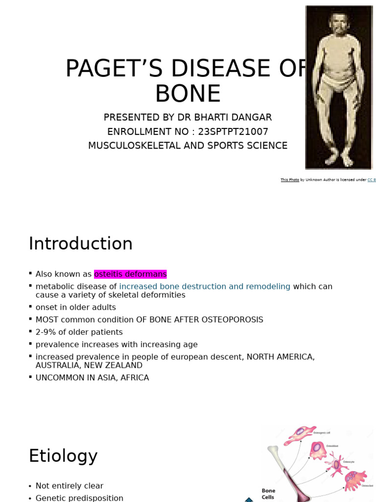 Paget's Disease of Bone | PDF
