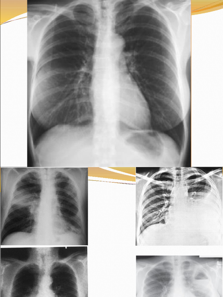 Les Différents Syndromes Radiologiques – NKSQU