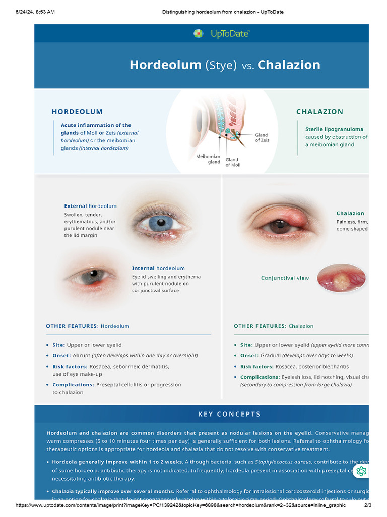 Distinguishing Hordeolum From Chalazion - UpToDate | PDF