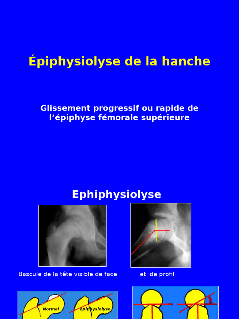 09 - Epiphysiolyse de Hanche | PDF