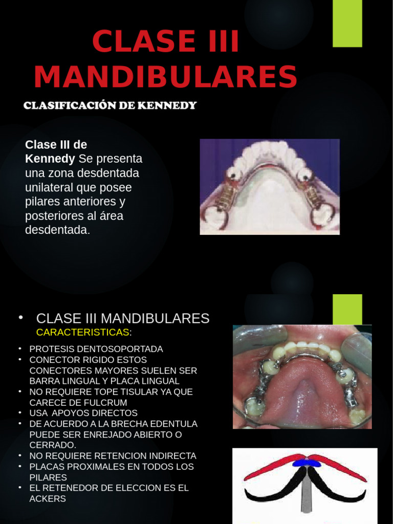 Tema #15 Clase III Mandibulares en PPR | PDF