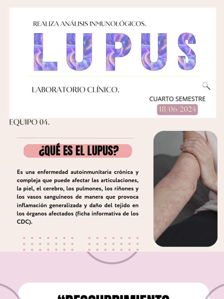 Lupus | PDF