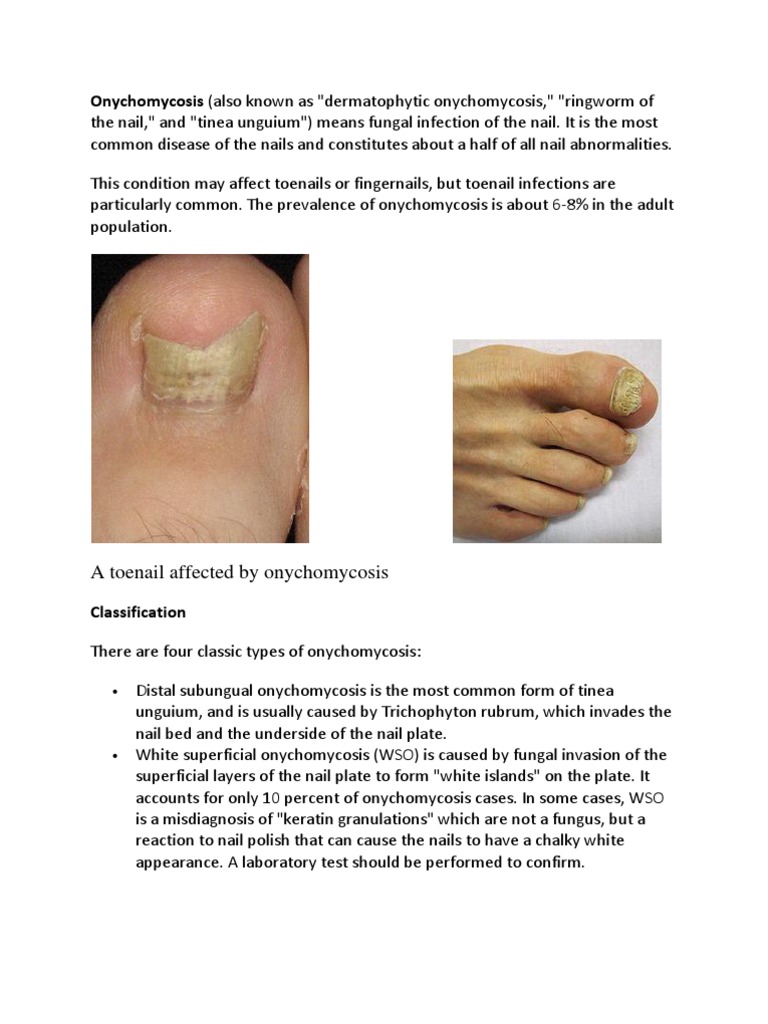 Onychomycosis (also known as "dermatophytic onychomycosis," "ringworm of