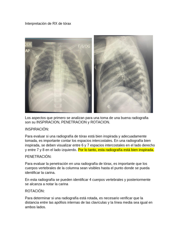 Interpretación de RX de Tórax | PDF