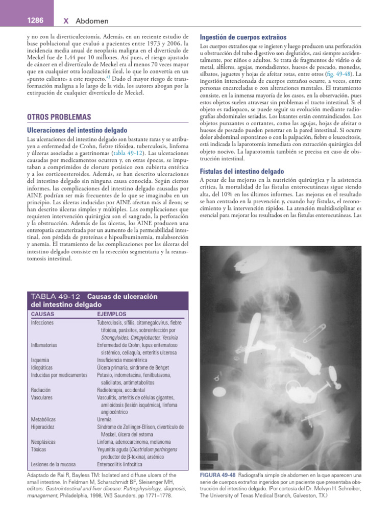 Fistulas Intestinales | PDF