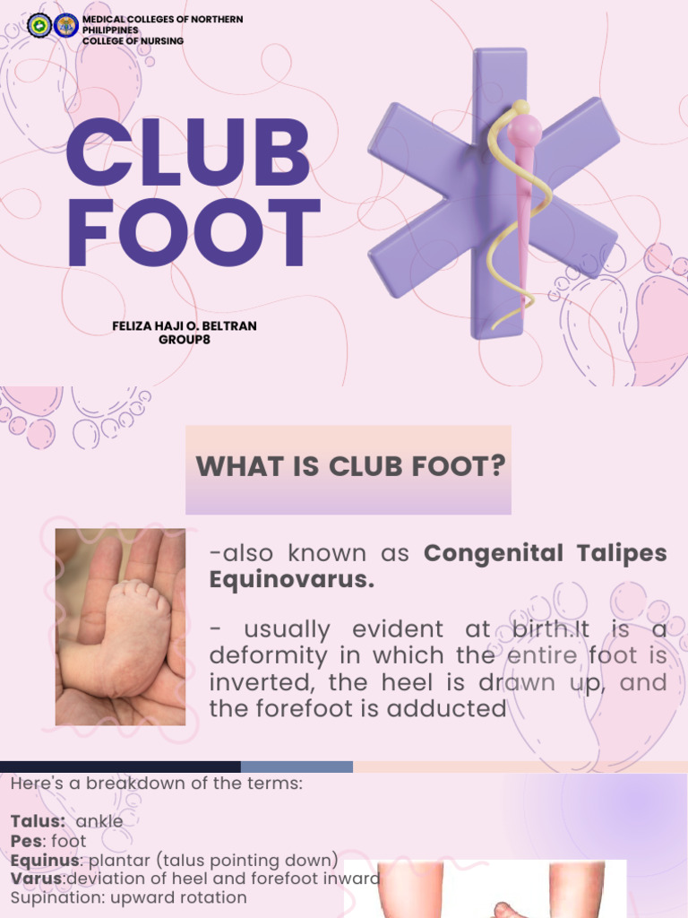 Club Foot | PDF