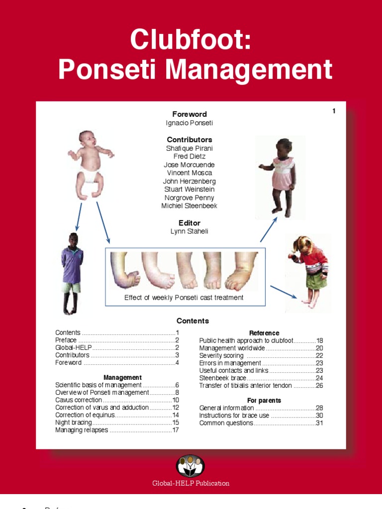 Clubfoot - Ponseti Management. Editor Lynn Stahelli (2003) | PDF | Foot ...